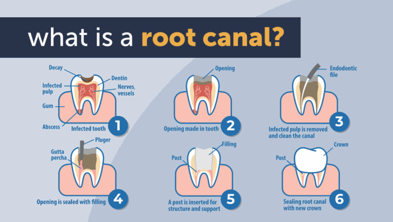 What Is a Root Canal? Procedure, Recovery & Alternatives