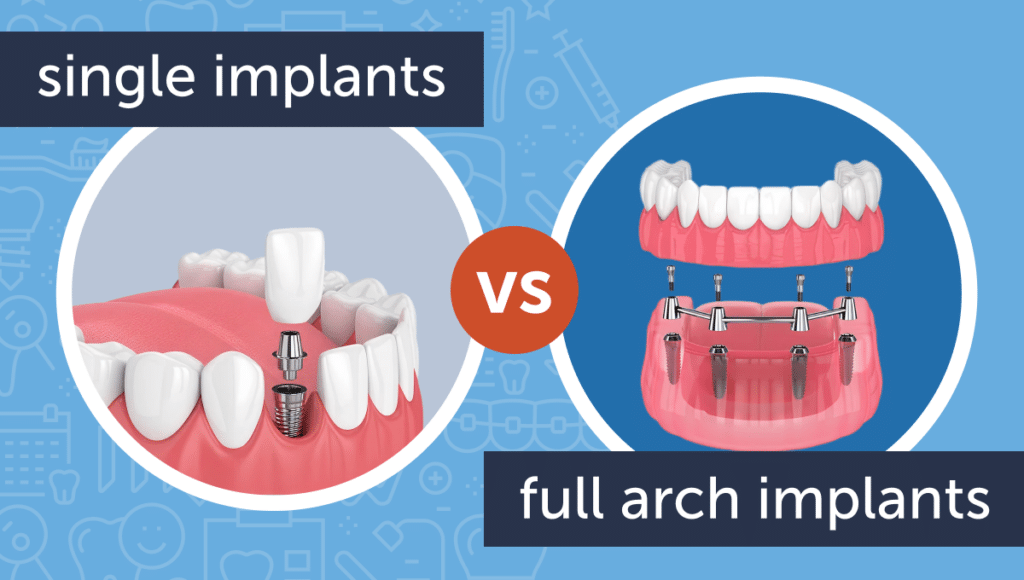 Single Tooth vs Full Arch Implants Explained